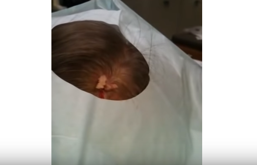 Removing A Pus Filled Cyst Pimple Popping Videos