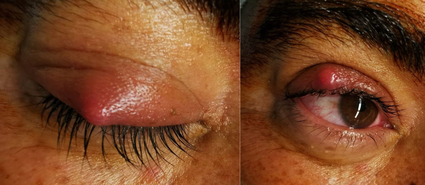 Unlocking the Mystery of Styes: Causes and Remedies - New Pimple ...
