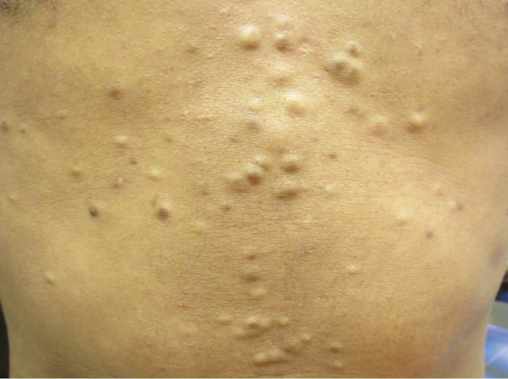 Which Diseases Cause Cyst Throughout The Body? - New Pimple Popping Videos