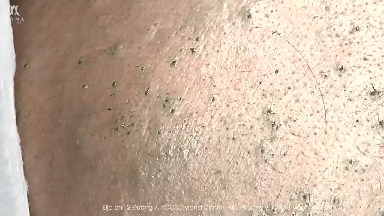 Large Blackheads Goldmine Satisfying Extractions - New Pimple Popping ...