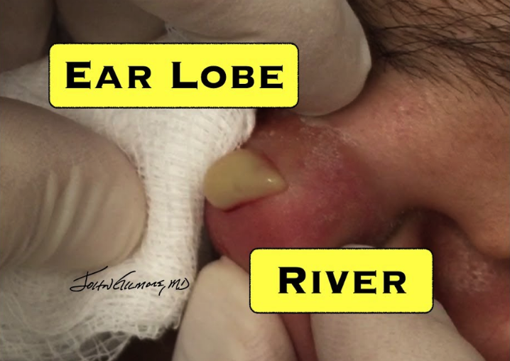 Earlobe Cyst Popping and Drainage - New Pimple Popping Videos