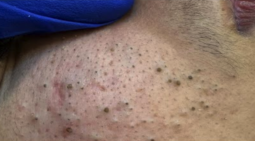 Advanced Large Blackheads Removal - New Pimple Popping Videos