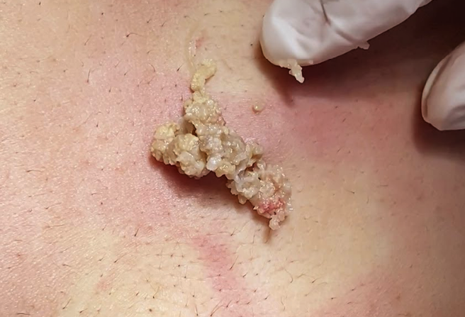 Cheese Cyst Incision and Drainage - New Pimple Popping Videos