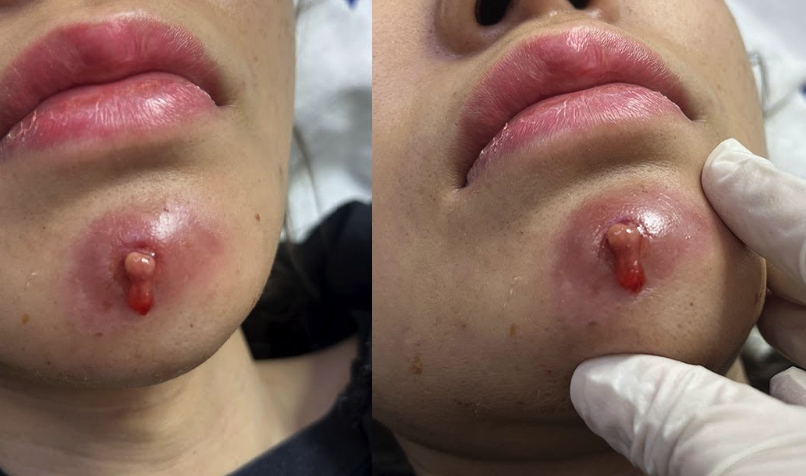 Cyst On Jaw Popped New Pimple Popping Videos